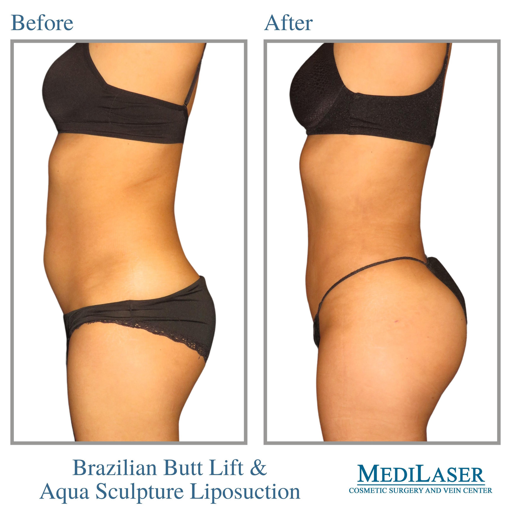 BBL Before & After | Medilaser | Frisco, TX